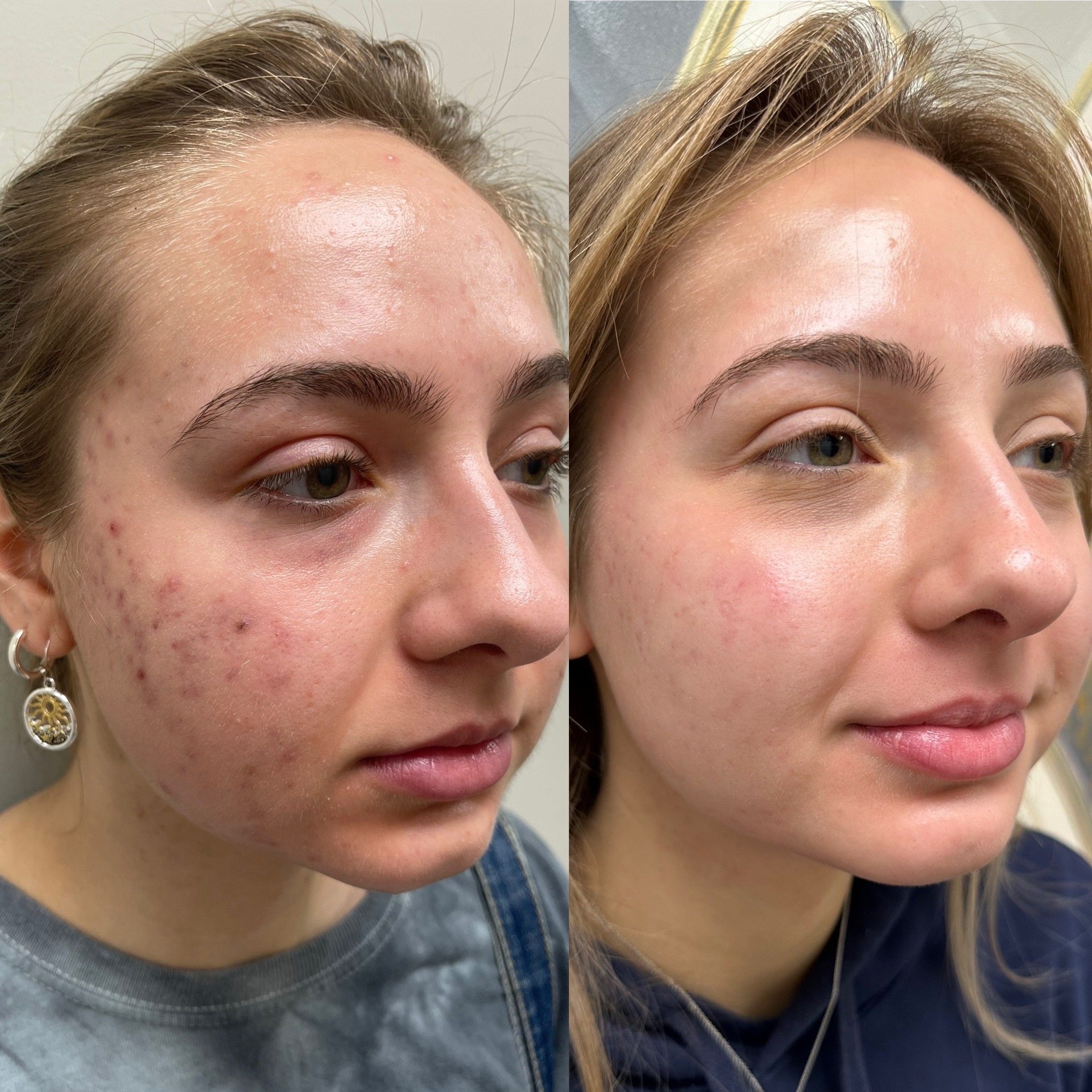 Acne Treatments - Jessica Elizabeth Skincare