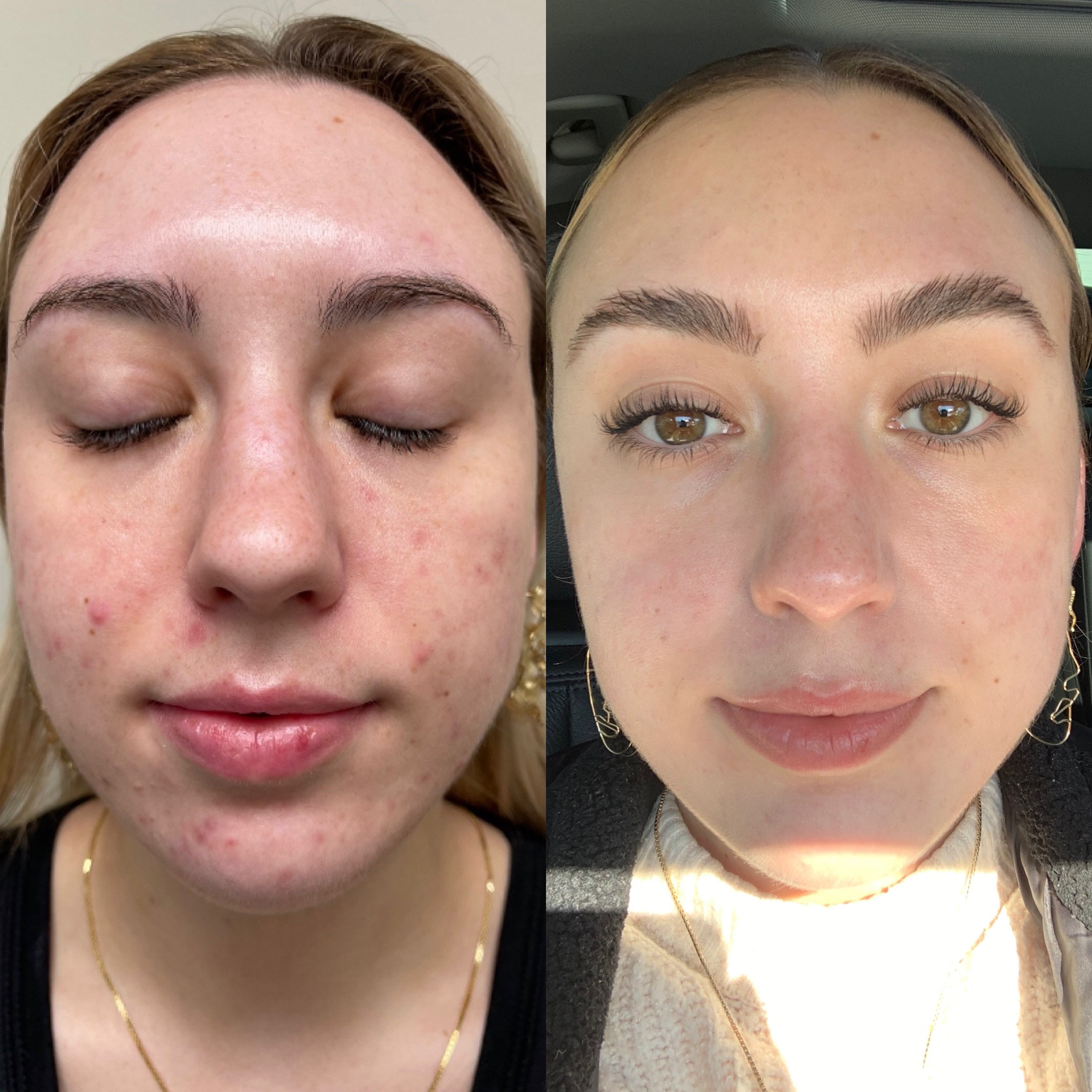 Acne Treatments - Jessica Elizabeth Skincare